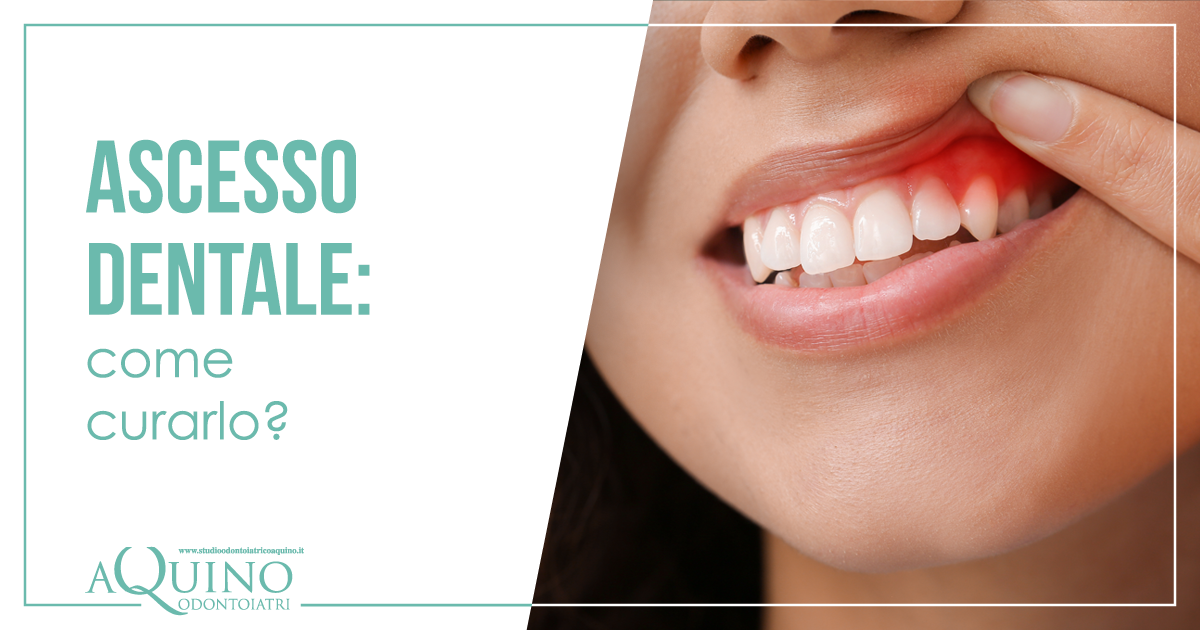 Come curare un ascesso dentale? | Studio Aquino